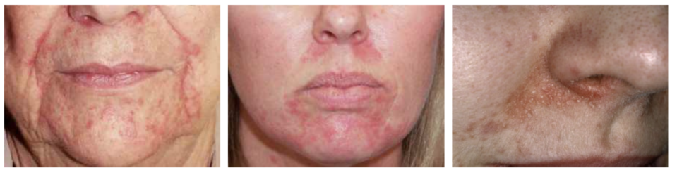 Perioral Dermatitis - Advanced Skin and Laser Center