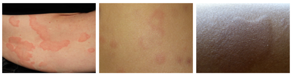 Urticaria (Hives) - Advanced Skin and Laser Center