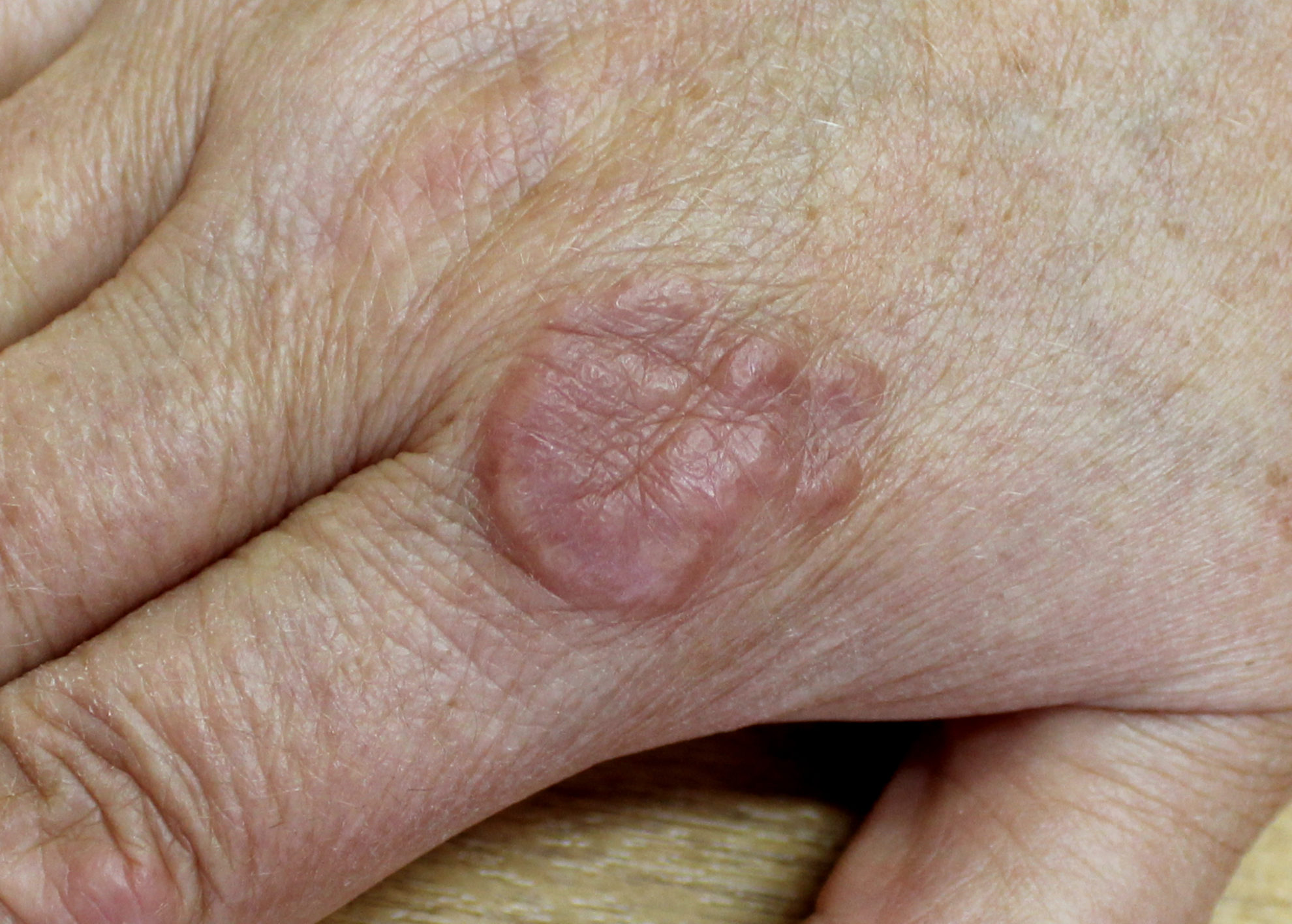 Granuloma Annulare - Advanced Skin and Laser Center