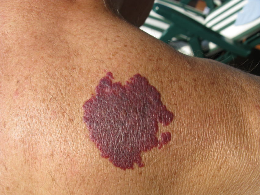 Birthmarks - Advanced Skin and Laser Center